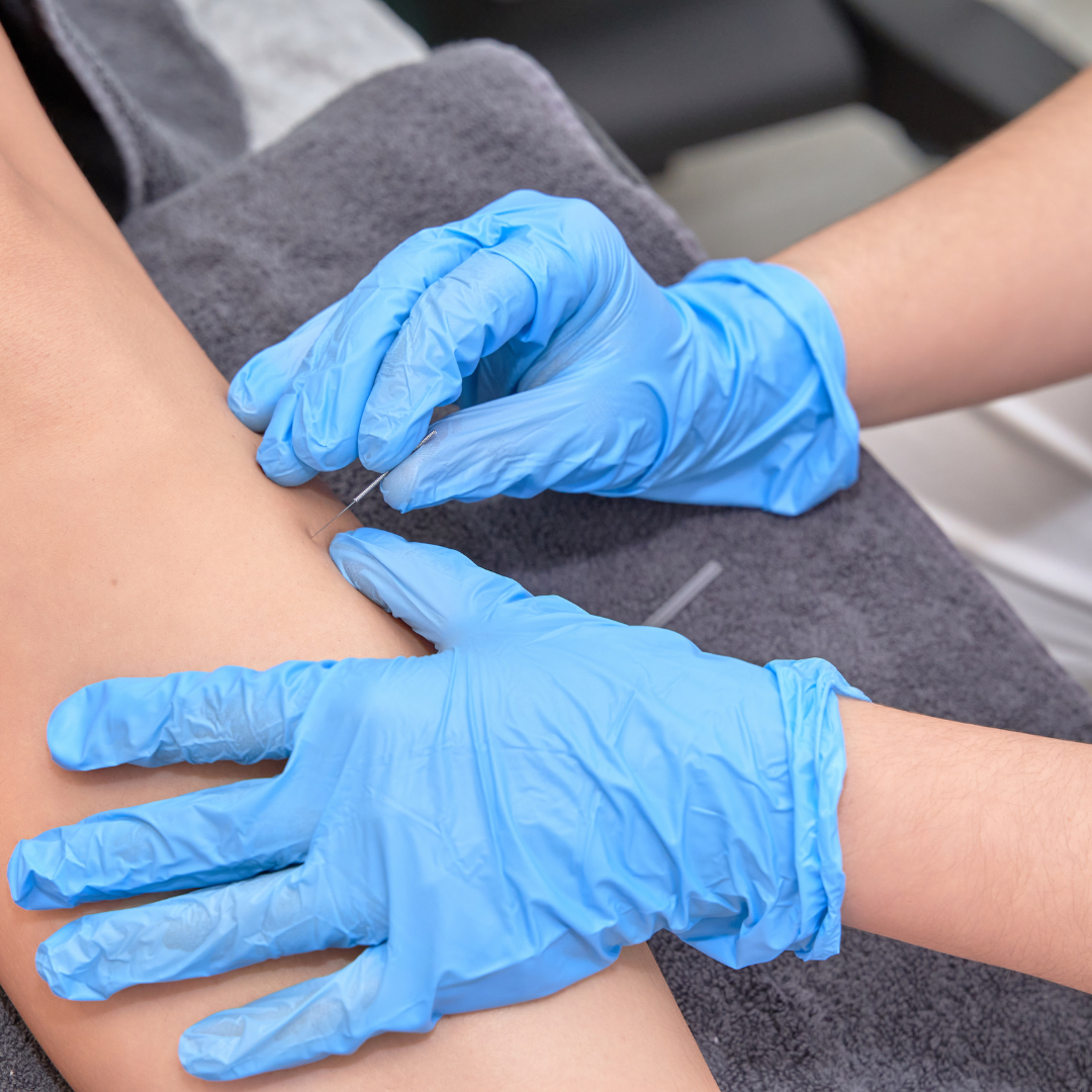 Dry Needling - Active Care